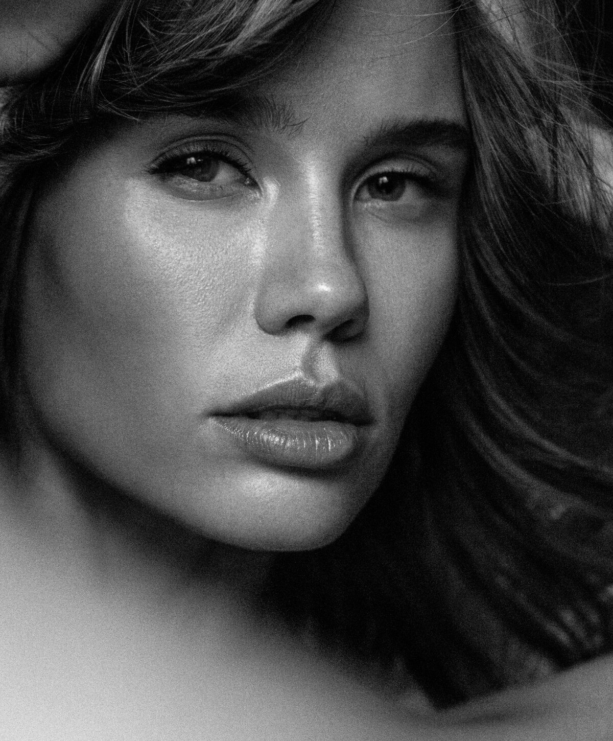 RHA Dermal Fillers in Toms River New Jersey | Belladerma Med Spa